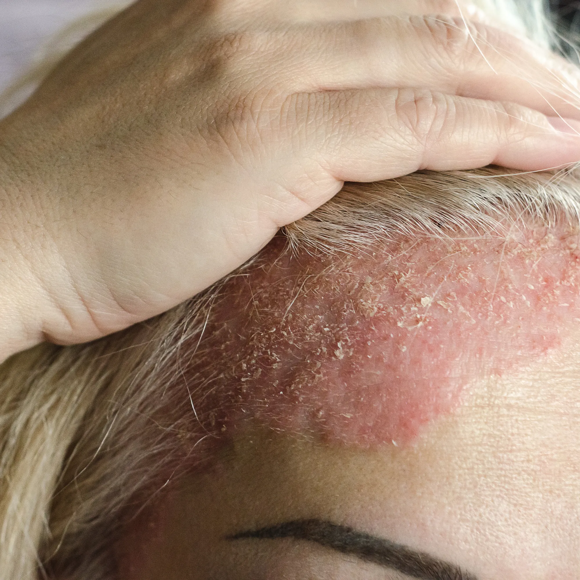 Seborrheic Dermatitis - Medical Clinic St Albans