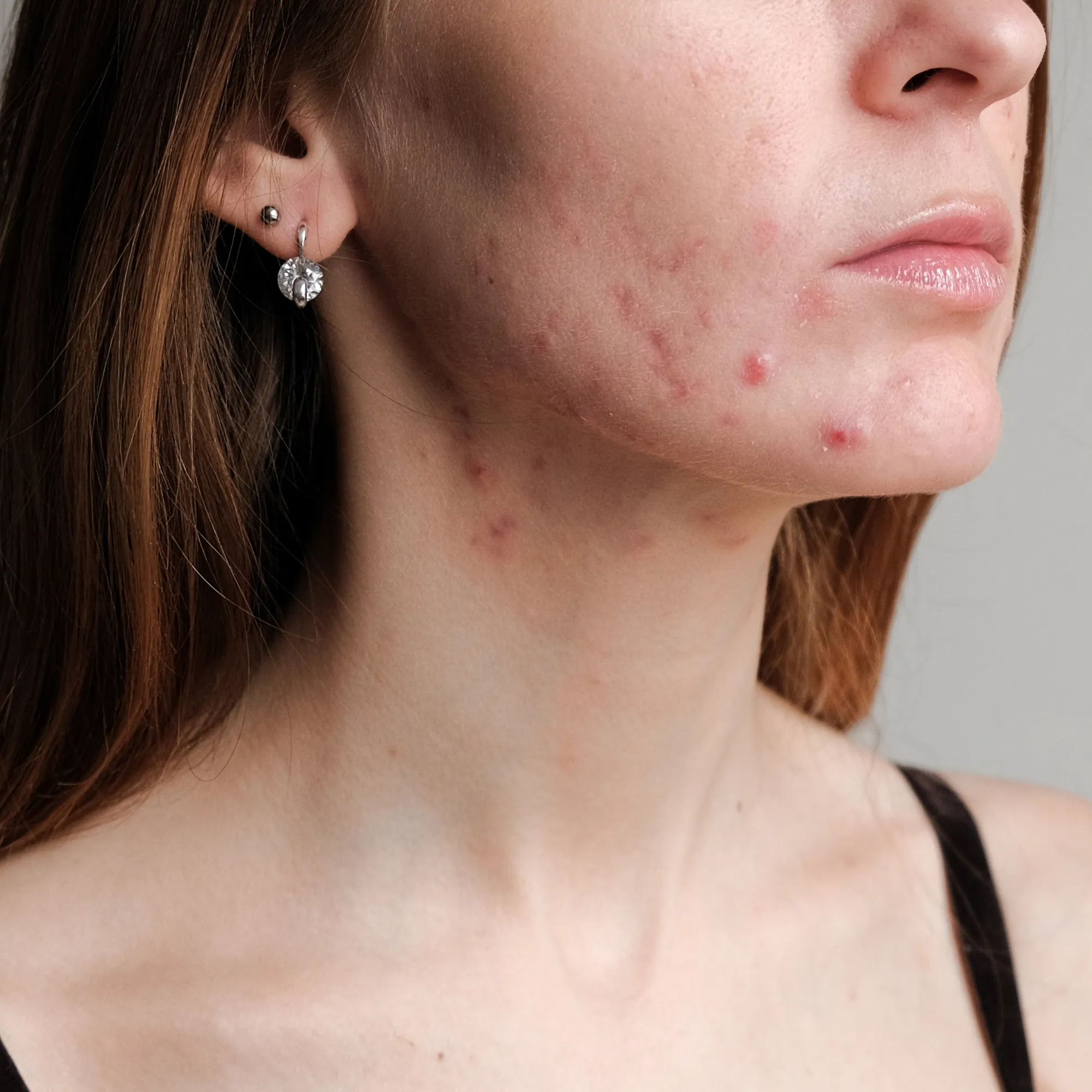Acne - Medical Clinic St Albans